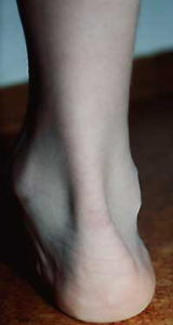 Knickfuß - Ursache, Auswirkungen, Therapie, Vorsorge